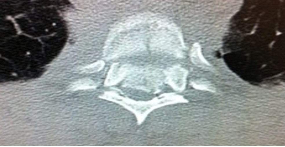 Traumatic T3 Burst Fracture