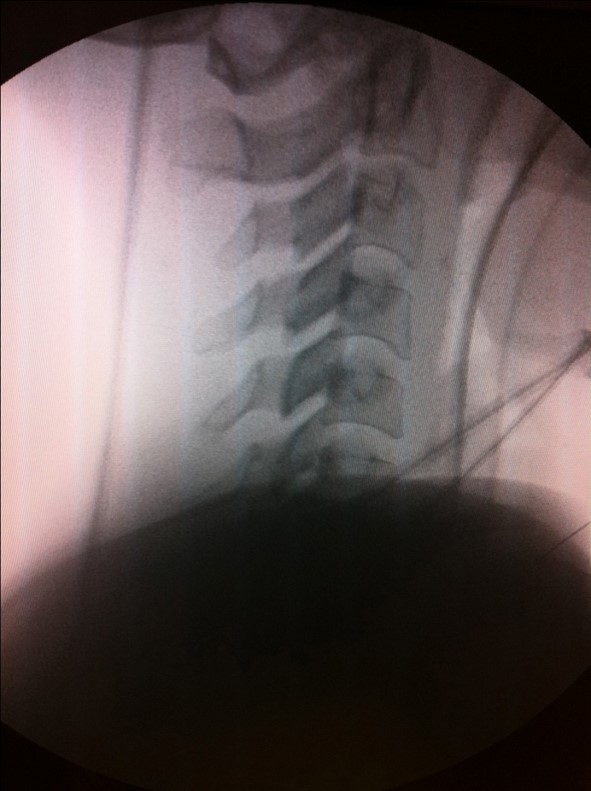 Traumatic T3 Burst Fracture