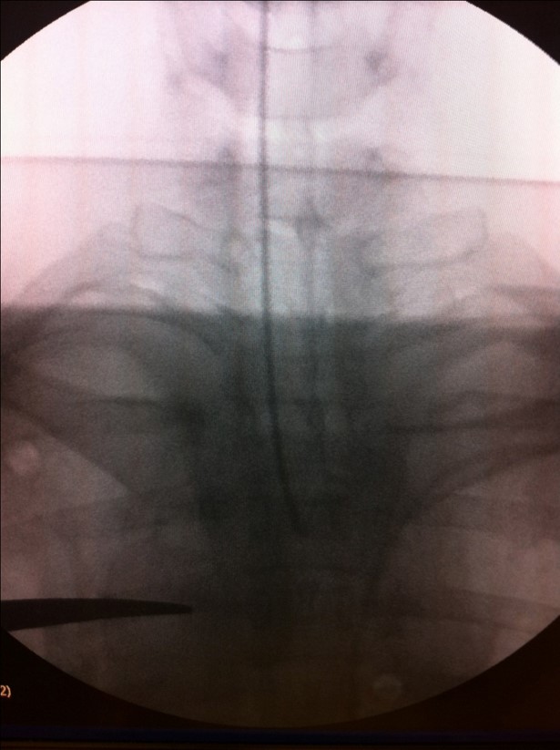Traumatic T3 Burst Fracture