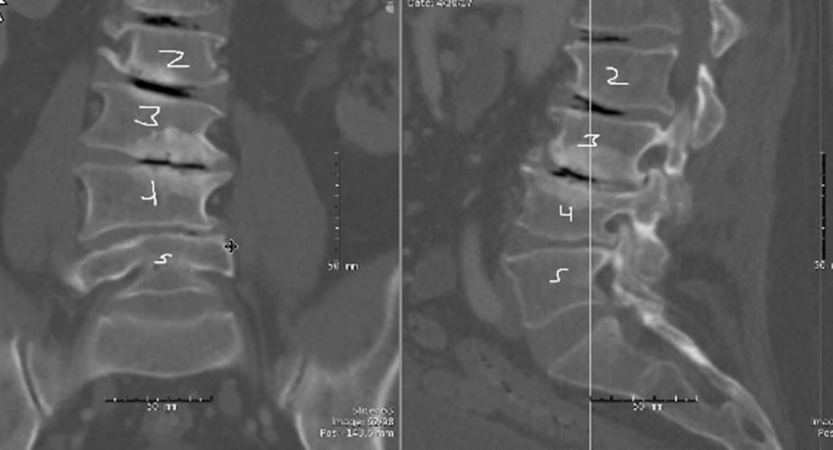 Lumbar Failed Back Surgery Post Laminectomy