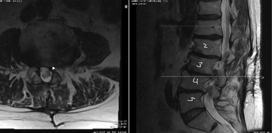 Lumbar Failed Back Surgery Post Laminectomy