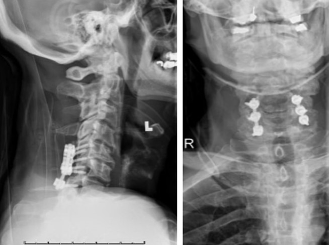 Myelopathy Secondary to C5-C7 Synovial Cyst