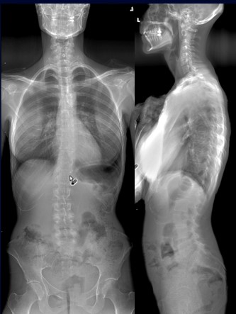 Single Position Spinal Surgery — Prone Lateral L3-L4