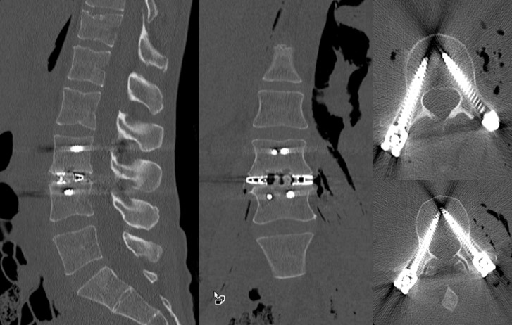 Single Position Spinal Surgery — Prone Lateral L3-L4