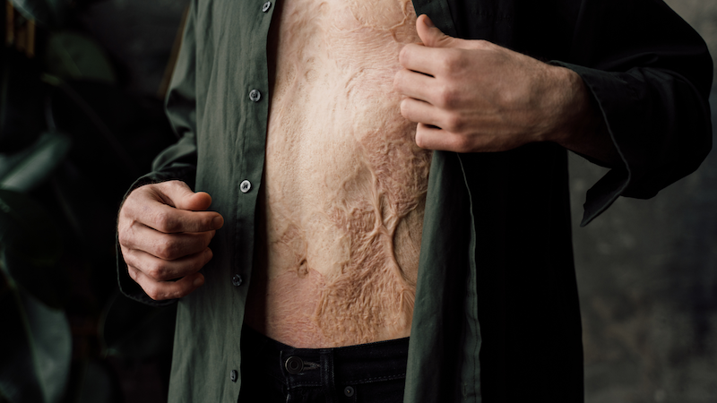 What to Know About Pain Management After a Burn Injury