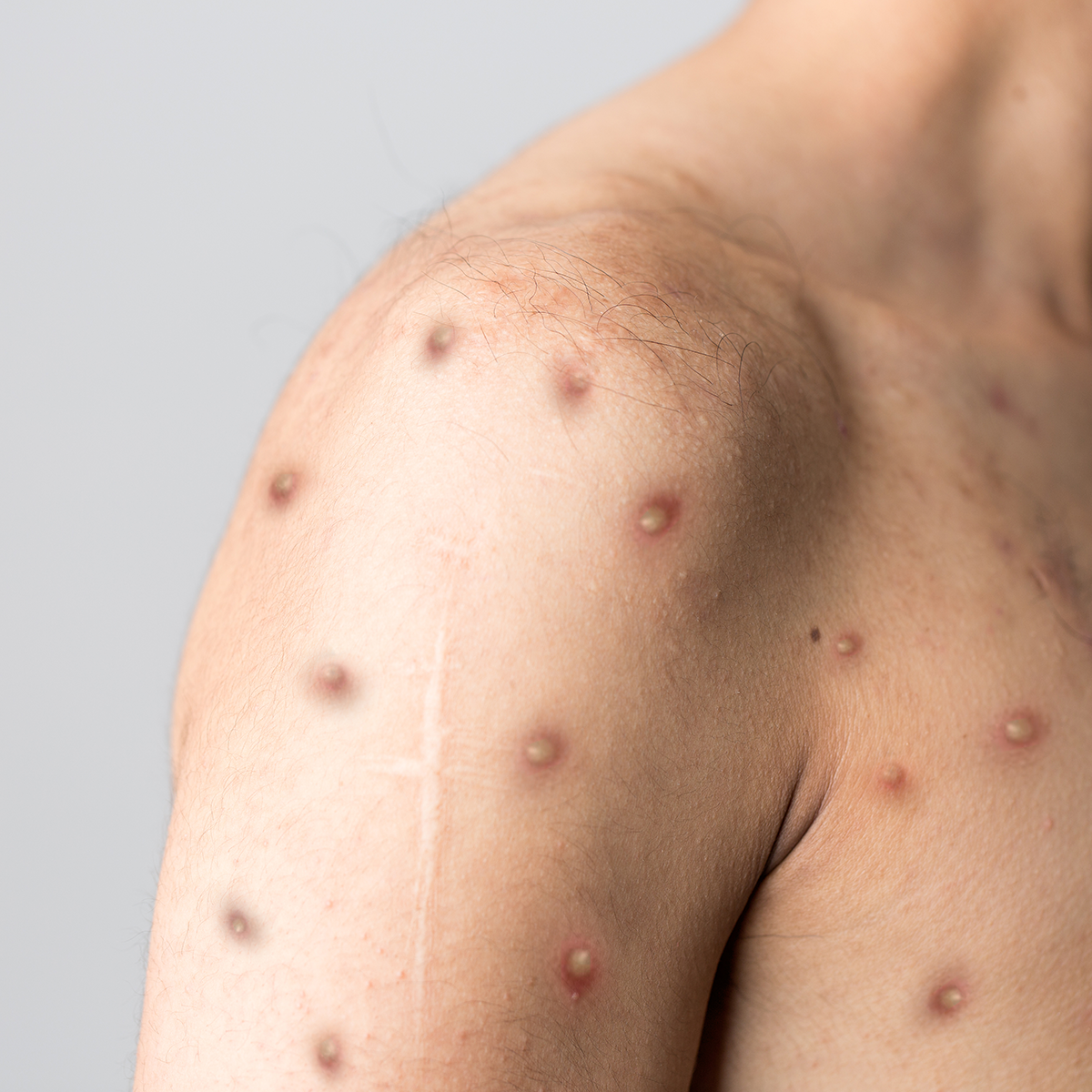 M-kopper (mpox) - Apotek 1