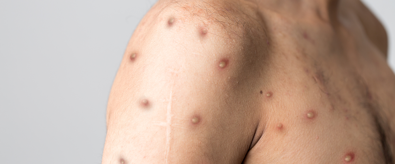 M-kopper (mpox) - Apotek 1