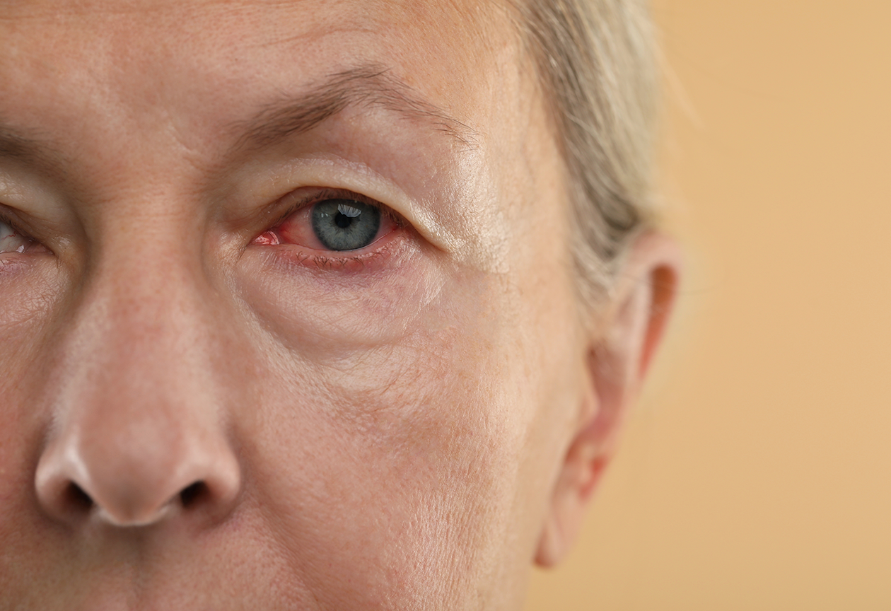 Øyelokksbetennelse (blefaritt) - symptomer, forebygging og behandling - Apotek 1