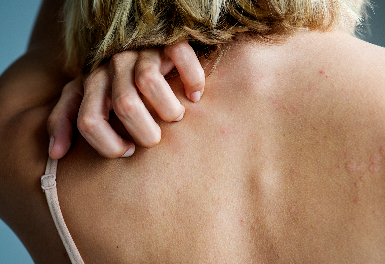 Keratosis pilaris - Apotek 1