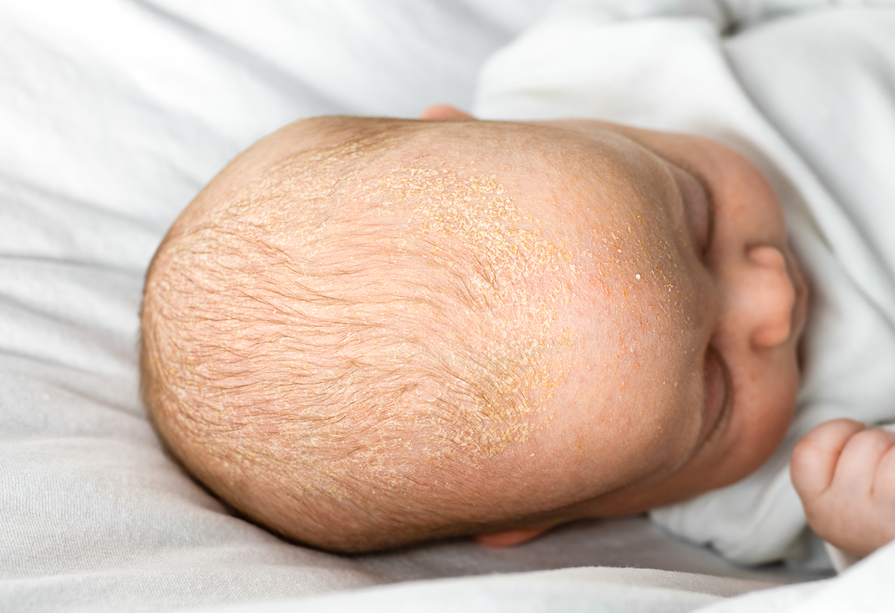 Perioral dermatitt – utslett rundt munnen - Apotek 1