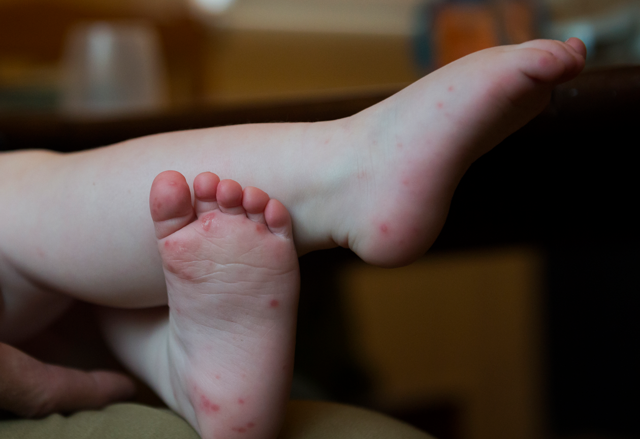 Fjerde barnesykdom - tredagersfeber og tredagersutslett - Apotek 1