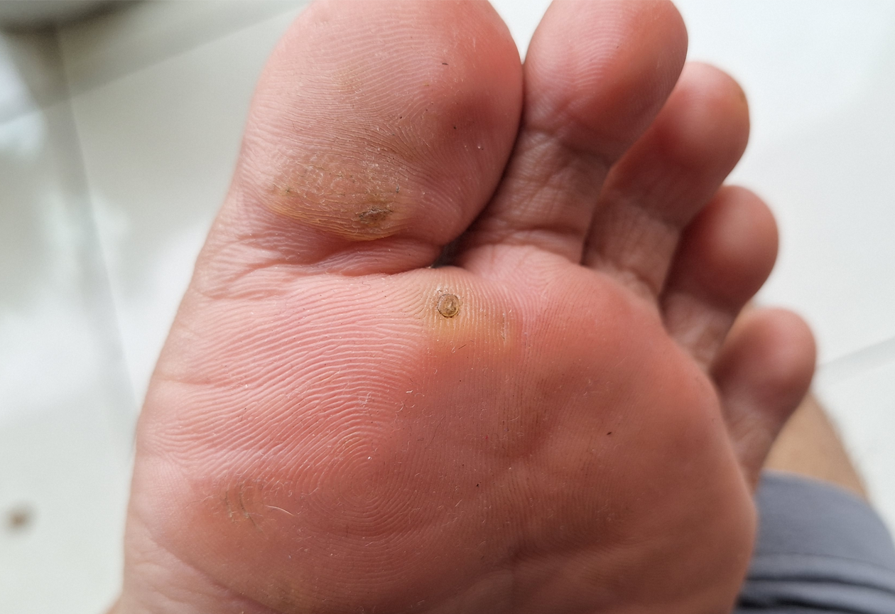 Liktorn – slik blir du kvitt den - Apotek 1