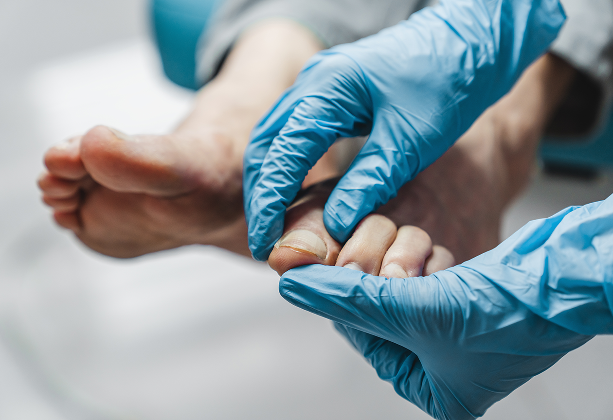 Skjev stortå (hallux valgus) - Apotek 1