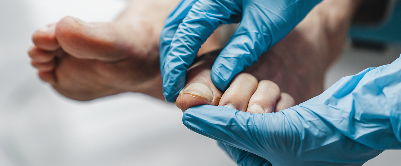 Inngrodd tånegl - Apotek 1