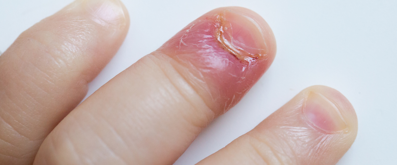 Neglerotbetennelse - Apotek 1