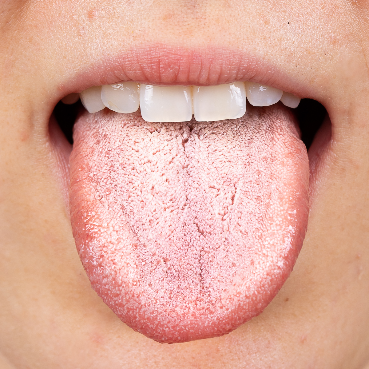 Sopp i munnen (trøske) - Apotek 1