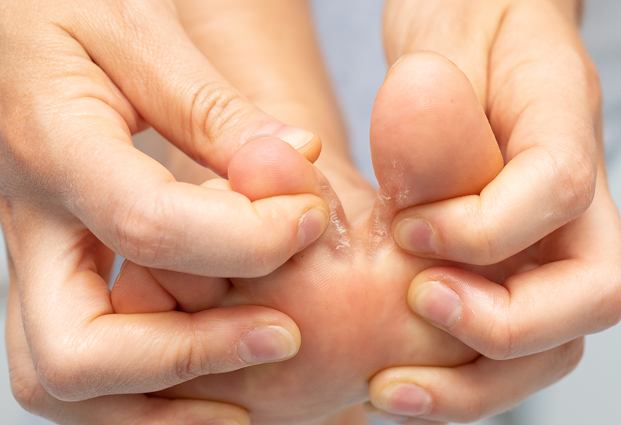 Fotsopp – hudsykdom og råd for behandling - Apotek 1