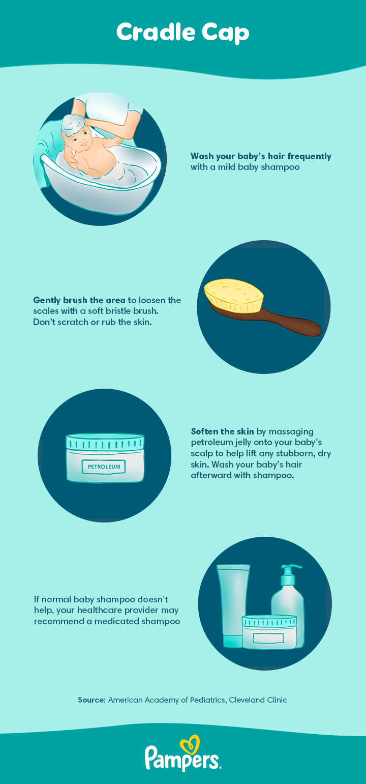 Cradle Cap Symptoms