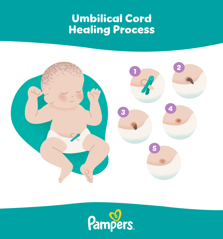 Umbilical Cord Healing Process