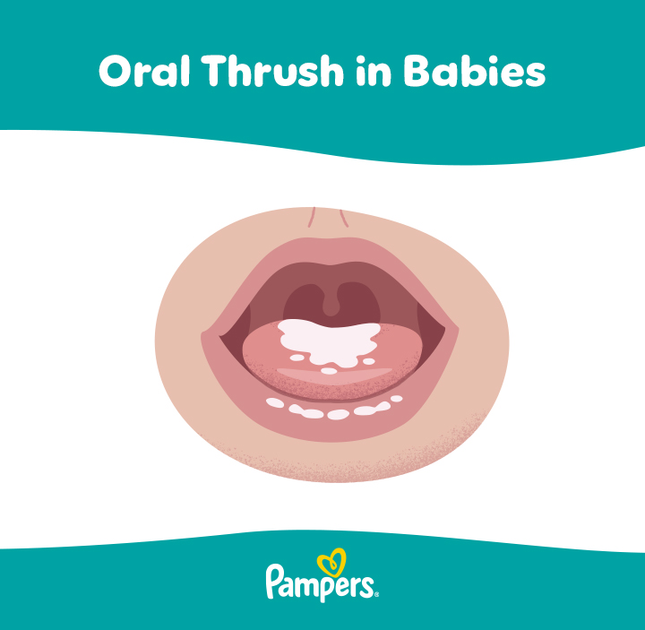 Oral Thrush Babies