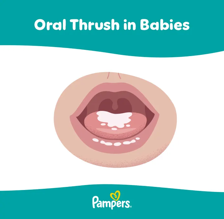 Thrush Under Tongue Oral Thrush: Online Treatment Tips, Pros & Cons
