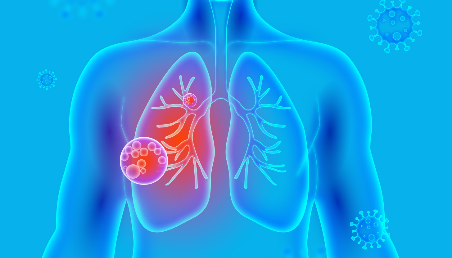 Pneumonia - Diagnosis and Management