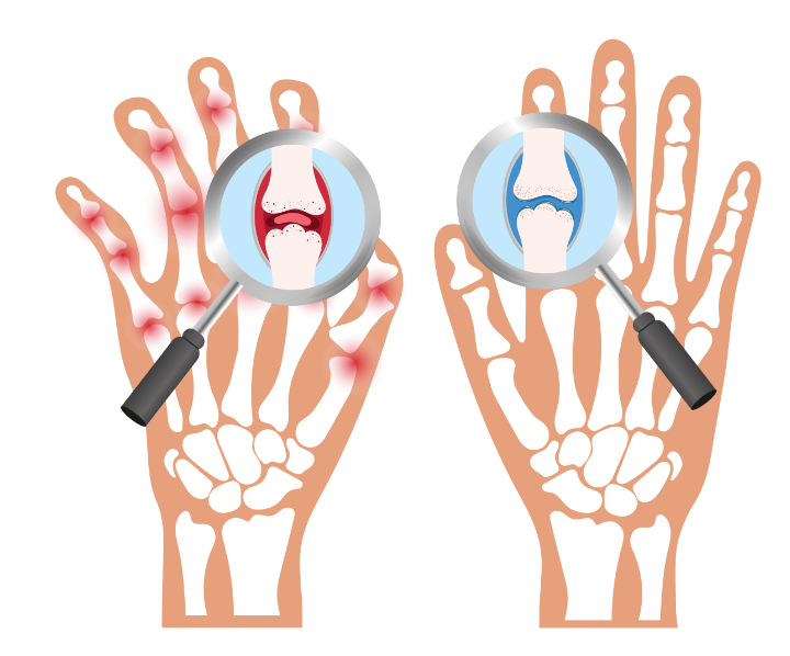 From Inflammation to Liberation: Therapies for Rheumatoid Arthritis ...