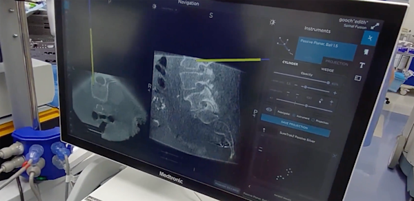 Ayer Neuroscience Institute uses new 3D exoscope for brain and spine ...