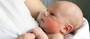 Baby Eczema Causes And Treatment Pampers Baby Eczema Causes And Treatment Pampers