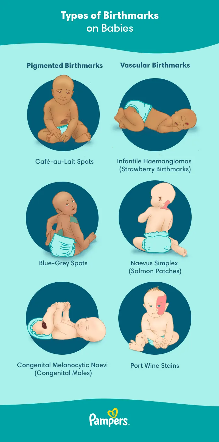 Baby Birthmarks: Types and Causes | Pampers UK