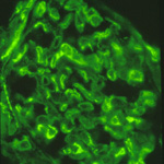 Canine Glomerulonephritis | Clinician's Brief