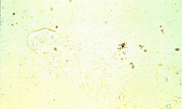Canine Glomerulonephritis