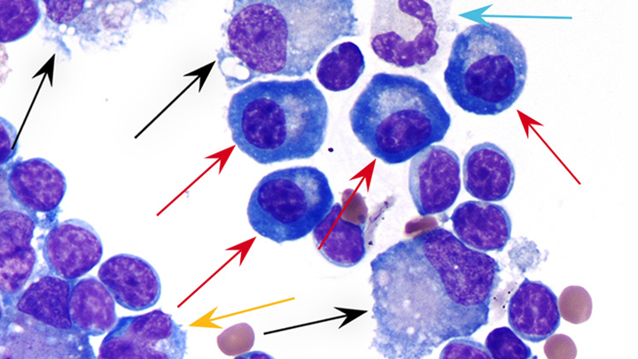 Image Gallery: Lymph Node Cytology | Clinician's Brief