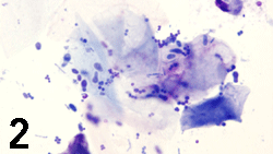 Otitis Externa | Clinician's Brief