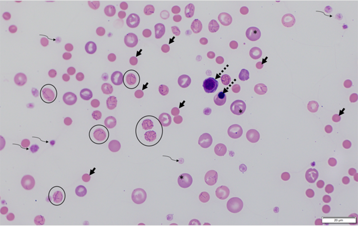 Top 5 Abnormalities Missed When a Blood Film Is Not Examined ...