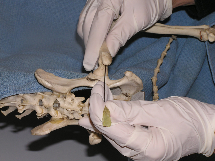 Intraosseous Catheterization: A Life-Saving Tool | Clinician's Brief