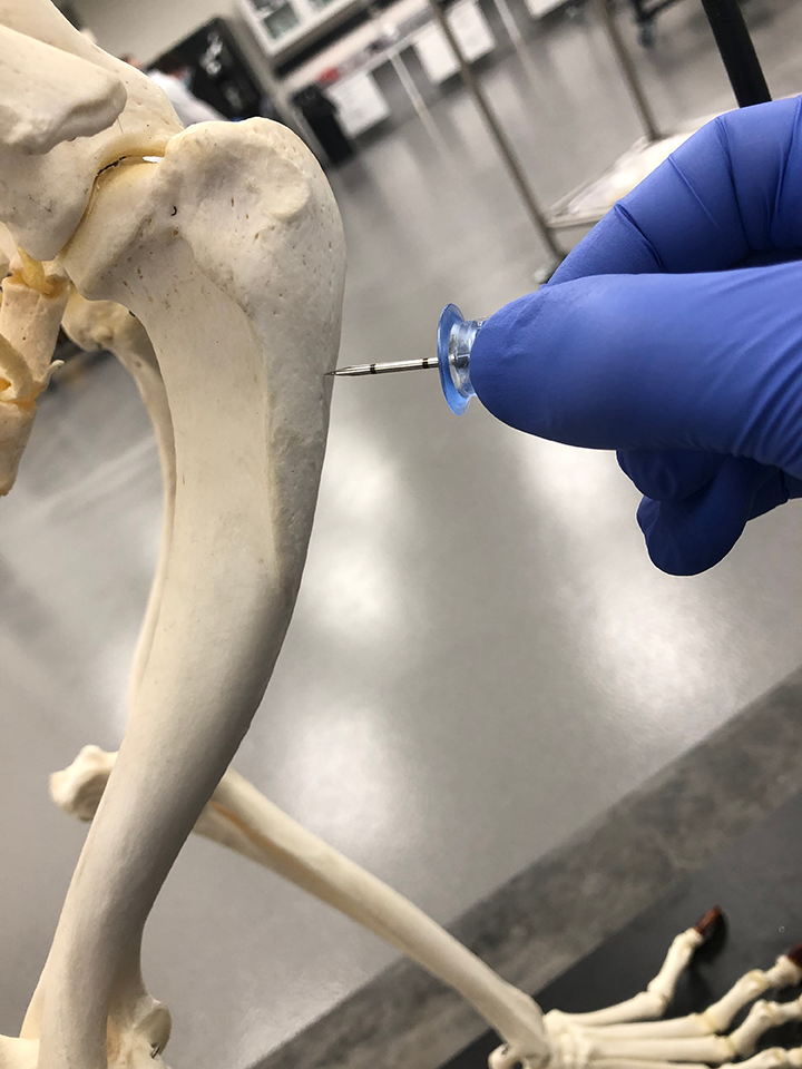 Alternative Methods for IV Access | Clinician's Brief