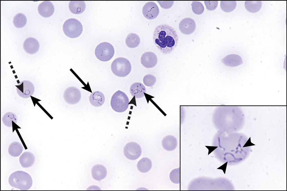 Babesiosis | Clinician's Brief