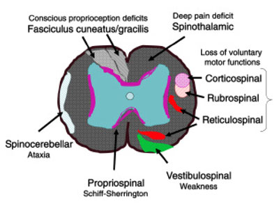 Emergency Management of Spinal Cord Lesions | Clinician's Brief