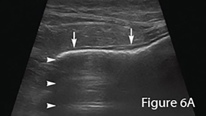 Imaging Intestinal Obstruction | Clinician's Brief