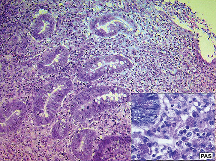 Top 5 Gastrointestinal & Hepatobiliary Antibiotics | Clinician's Brief