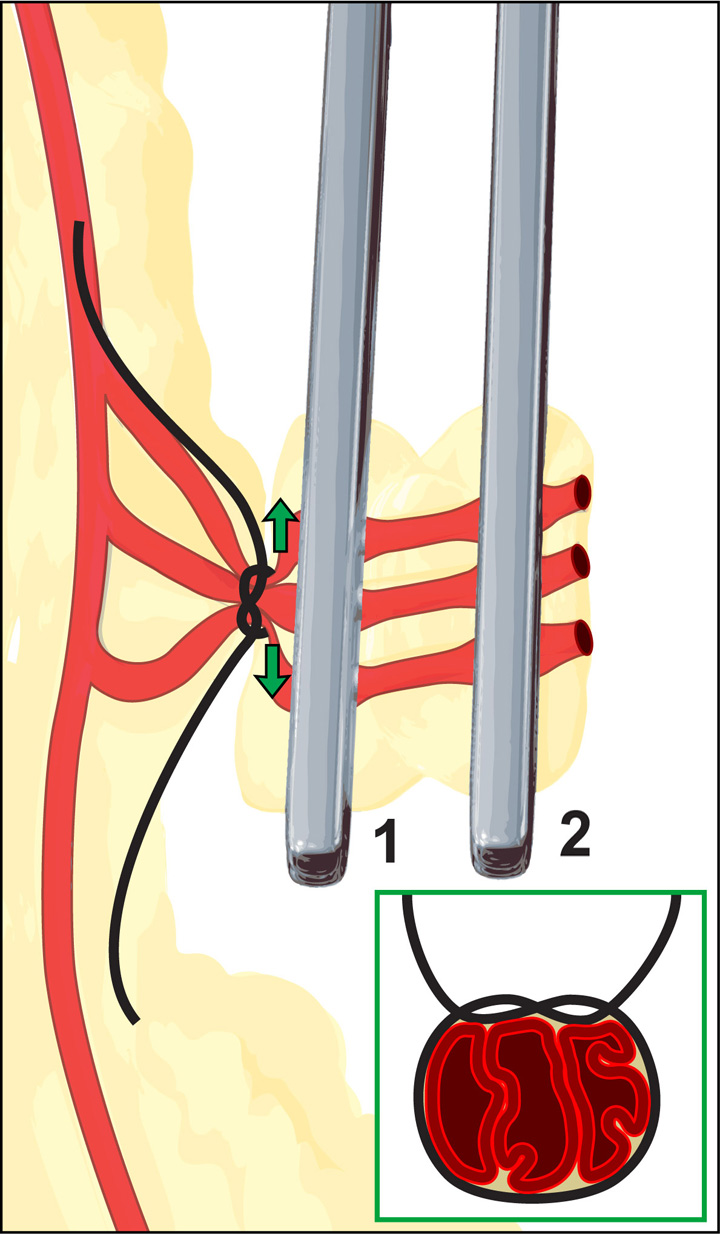 Total Splenectomy | Clinician's Brief