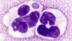 What Your Hematology Analyzer Can't Tell You | Clinician's Brief
