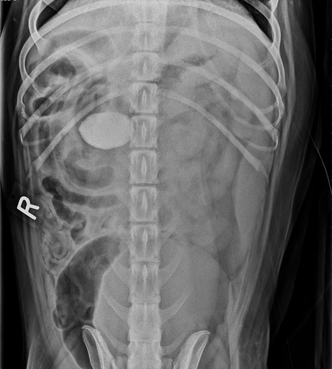 Known Foreign Body Ingestion | Clinician's Brief