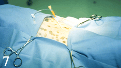 Diagnostic Peritoneal Lavage | Clinician's Brief