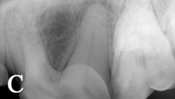 Dental Attrition: A Case-by-Case Review | Clinician's Brief