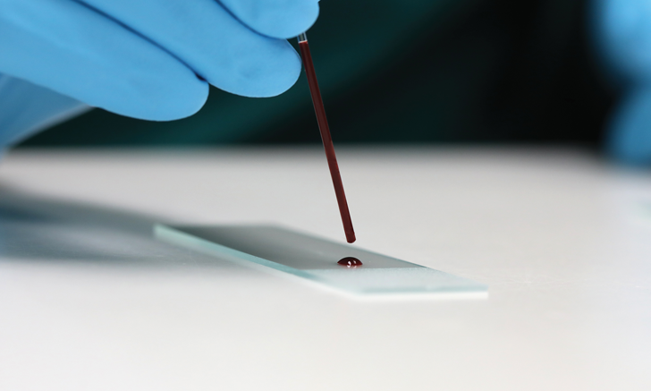Diagnostic Blood Smear Preparation