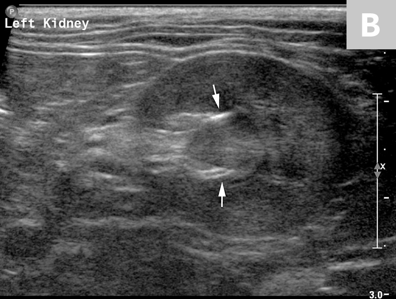 Diagnostic Imaging of Urinary Tract Calculi | Clinician's Brief