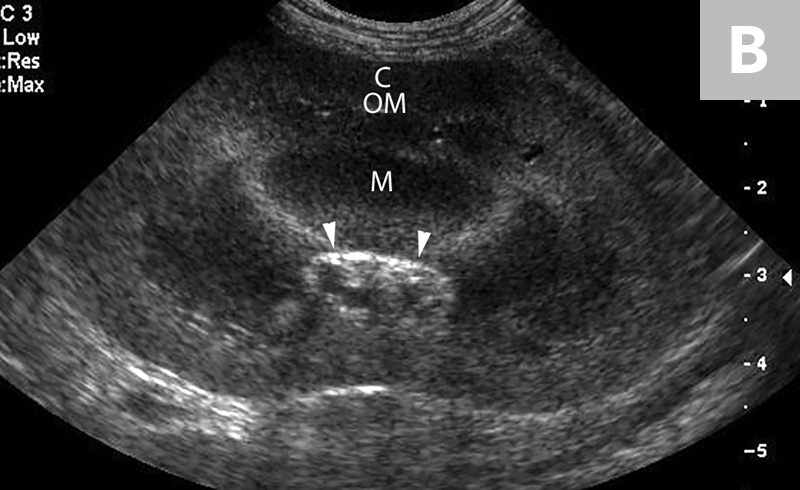 Diagnostic Imaging of Urinary Tract Calculi | Clinician's Brief