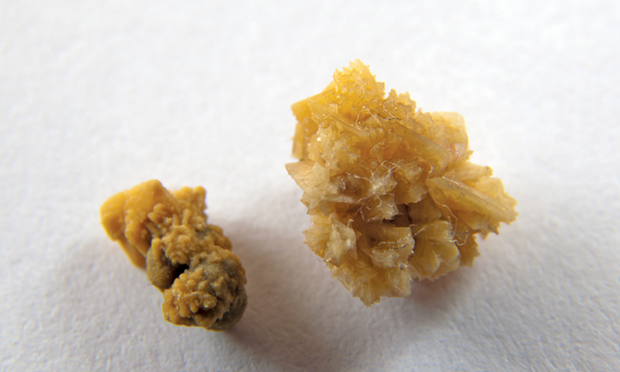 Cytology Challenge: Unusual Sediment Findings | Clinician's Brief